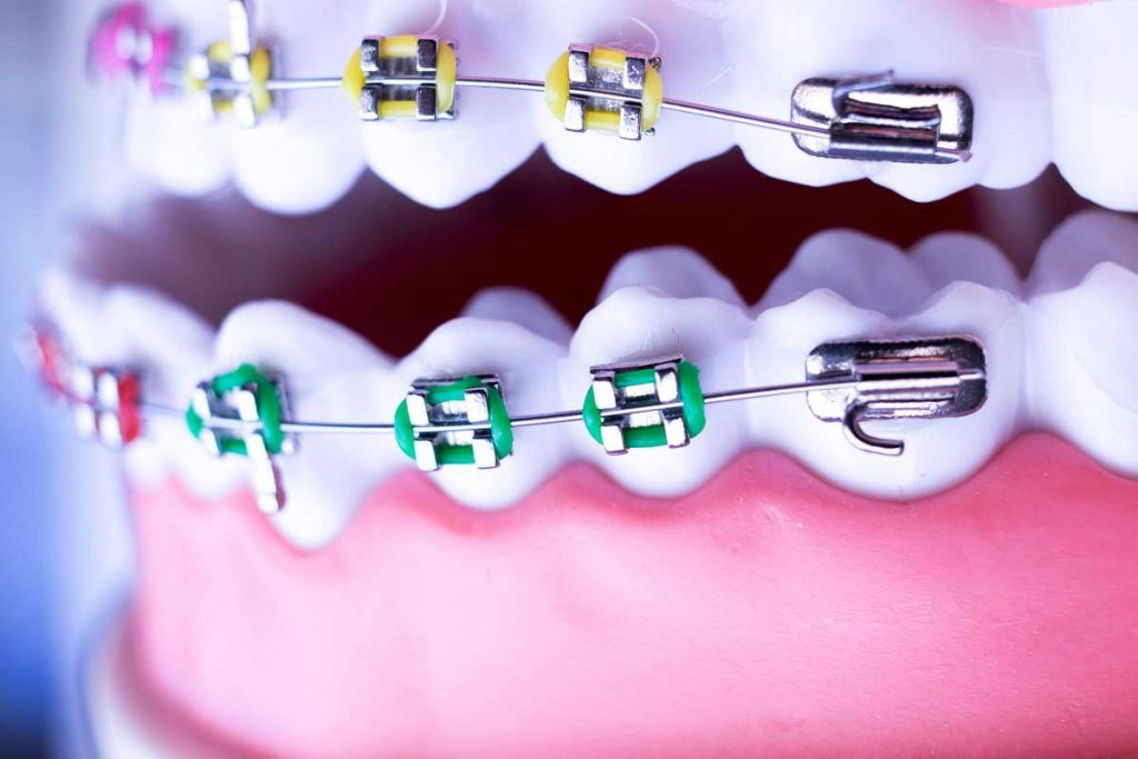 Orthodontic Applications - Estevitalya